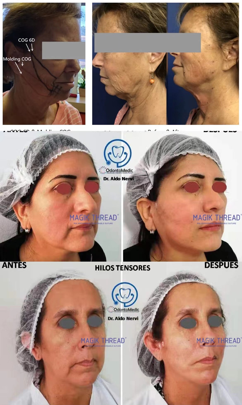 Have you learnt about long threads? - Dermax Aesthetics